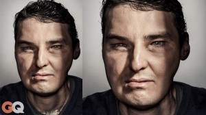 The World's 23rd Full Face Transplant Was A Roaring Success: One Year ...