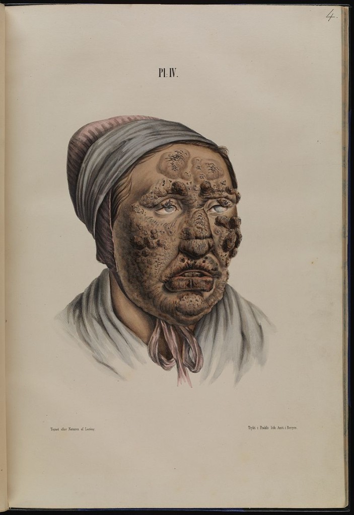 Leprosy In Art: Disease And Beauty • Lazer Horse