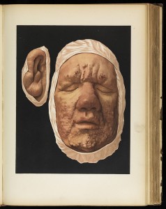 Leprosy in Art - Leper's Face - Lazer Horse